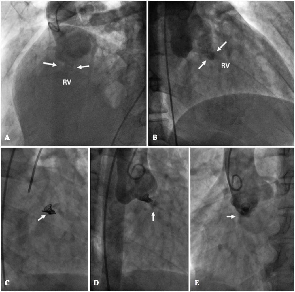 Percutaneous occlusion of ruptured Valsalva sinus aneurysms into the ...