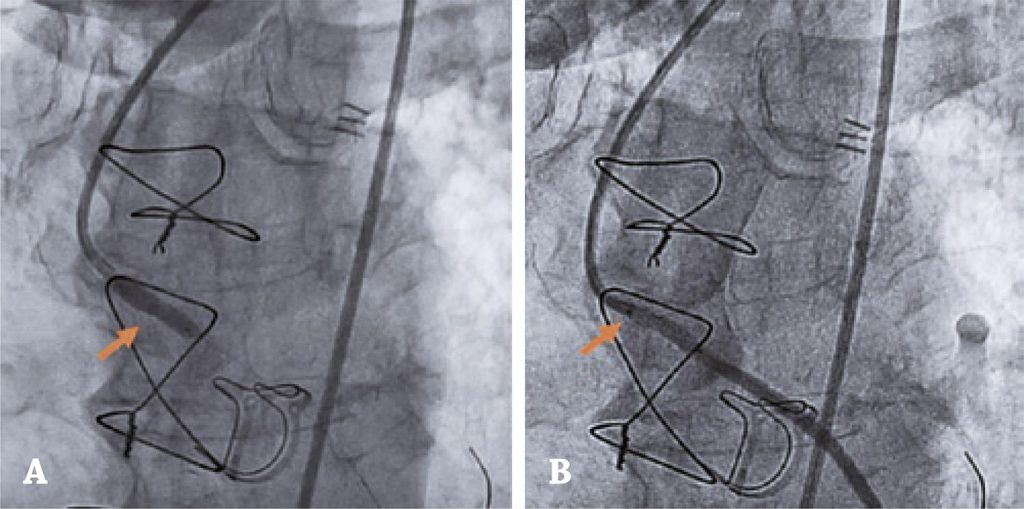 Iatrogenic left main and right coronary ostial occlusion following ...