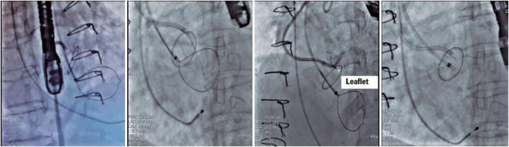 Basilica procedure for prevention of coronary obstruction during ...