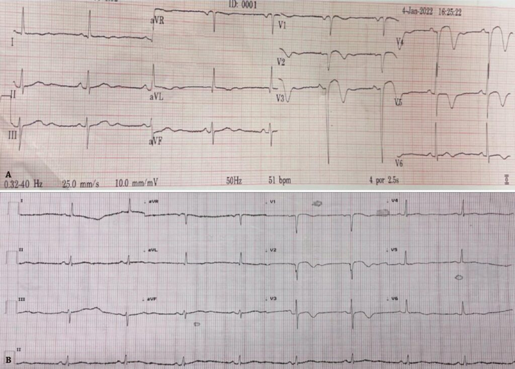 Wellens Syndrome: impending acute myocardial infarction - Journal of ...
