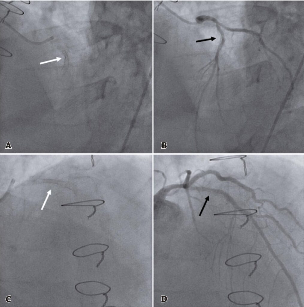 Excimer Laser coronary atherectomy as adjunctive treatment of severe ...
