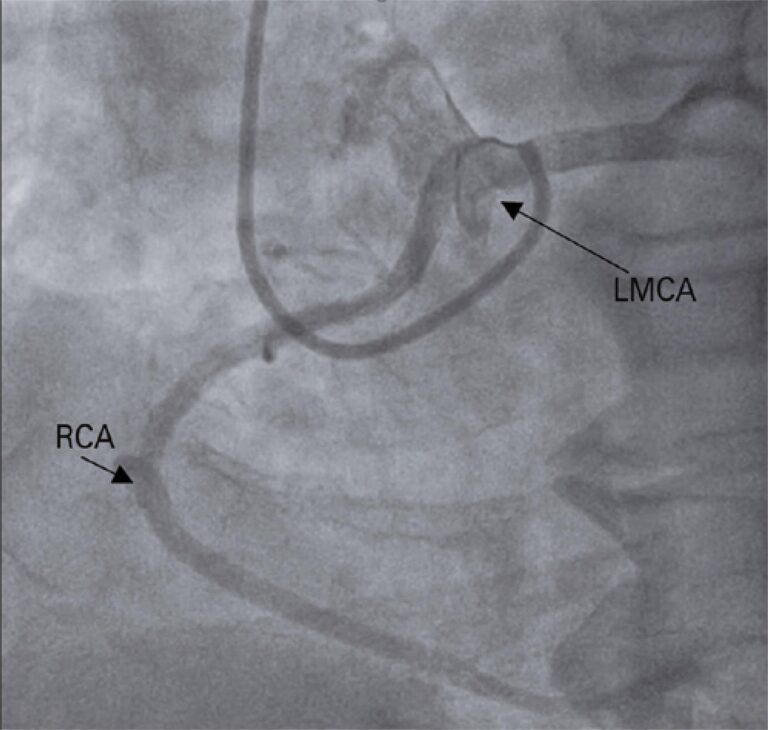 Percutaneous treatment of anomalous origin of the right coronary artery ...